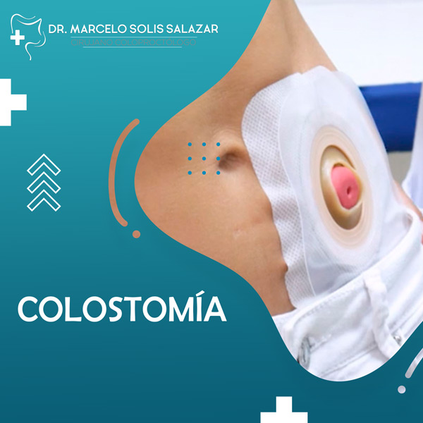 Dr. Marcelo Solis - Colostomía